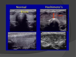 H&n sonographic anatomy of the neck and diffuse thyroid | PDF