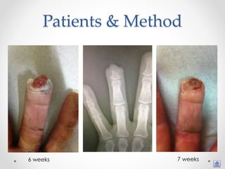 Experience with semi occlusive dressing in fingertip injuries | PPTX