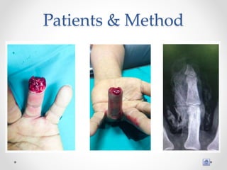 Experience with semi occlusive dressing in fingertip injuries | PPTX