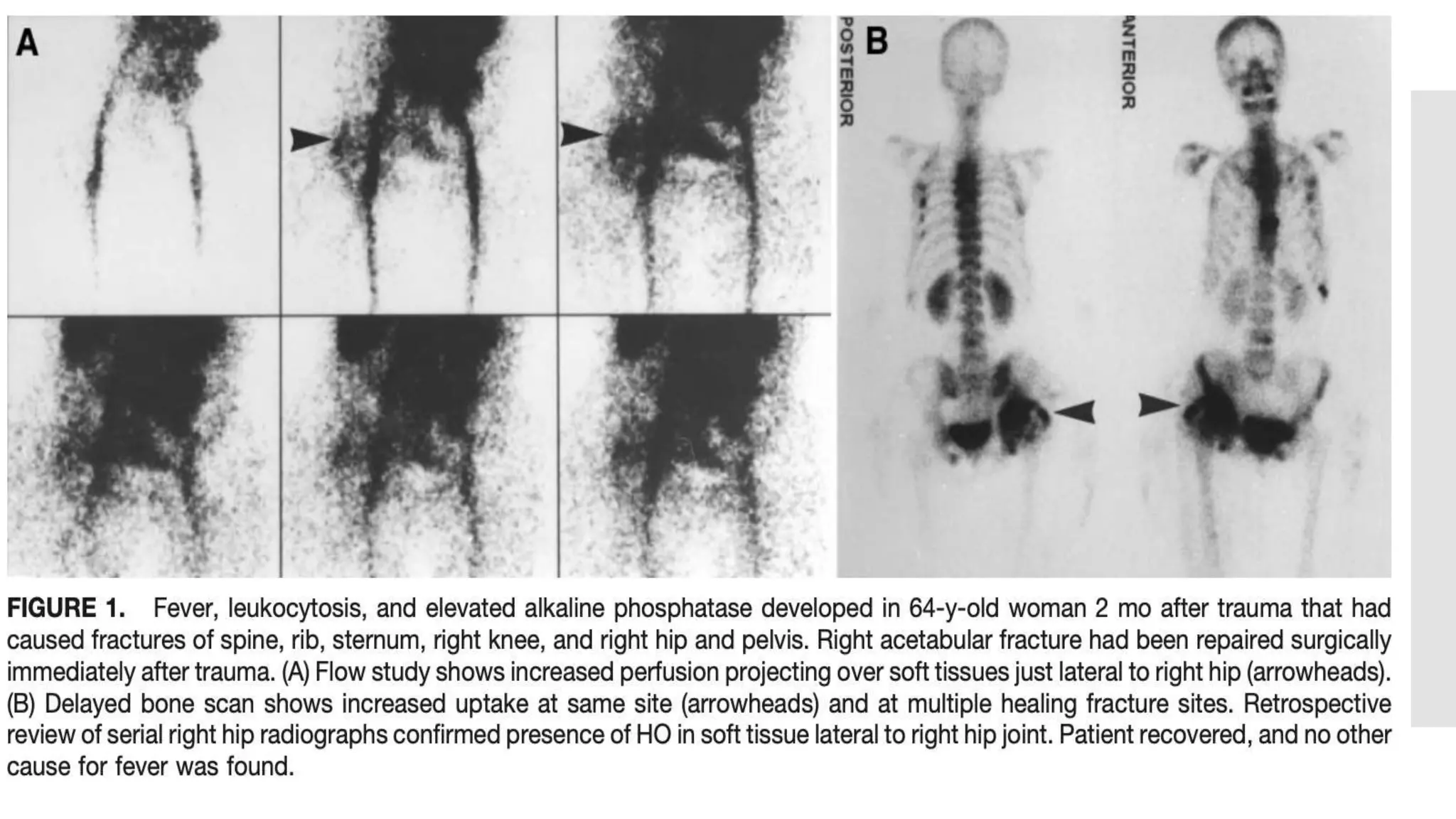 Heterotcopic classification For the role of bone scan | PPT
