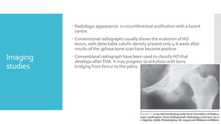 Heterotcopic classification For the role of bone scan | PPTX