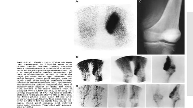 Heterotcopic classification For the role of bone scan | PPT