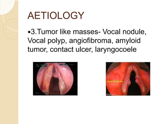 Hoarseness of voice | PPTX