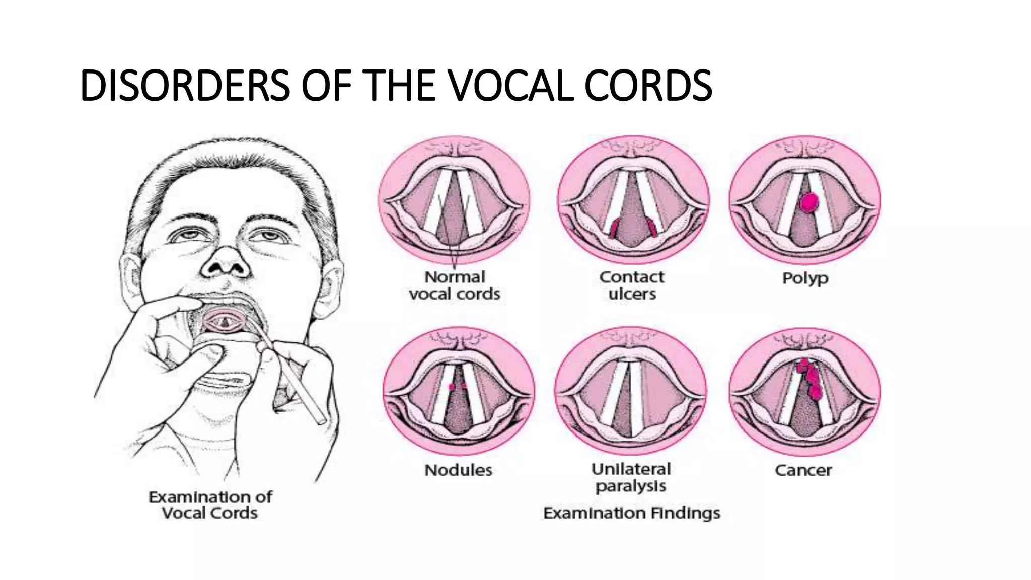 HOARSENESS OF VOICE [Recovered].pptx