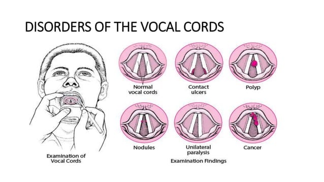 HOARSENESS OF VOICE [Recovered].pptx | Ear, Nose and Throat Conditions ...