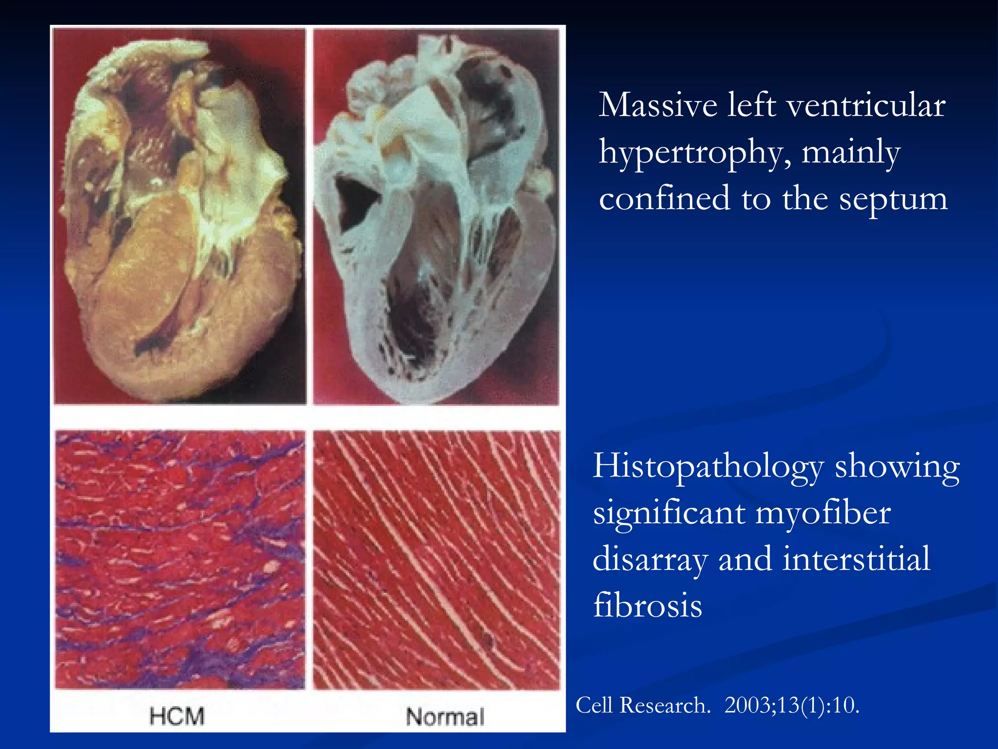 HYPERTROPHIC OBSTRUCTIVE CARDIOMYOPATHY (HOCM) | PPT