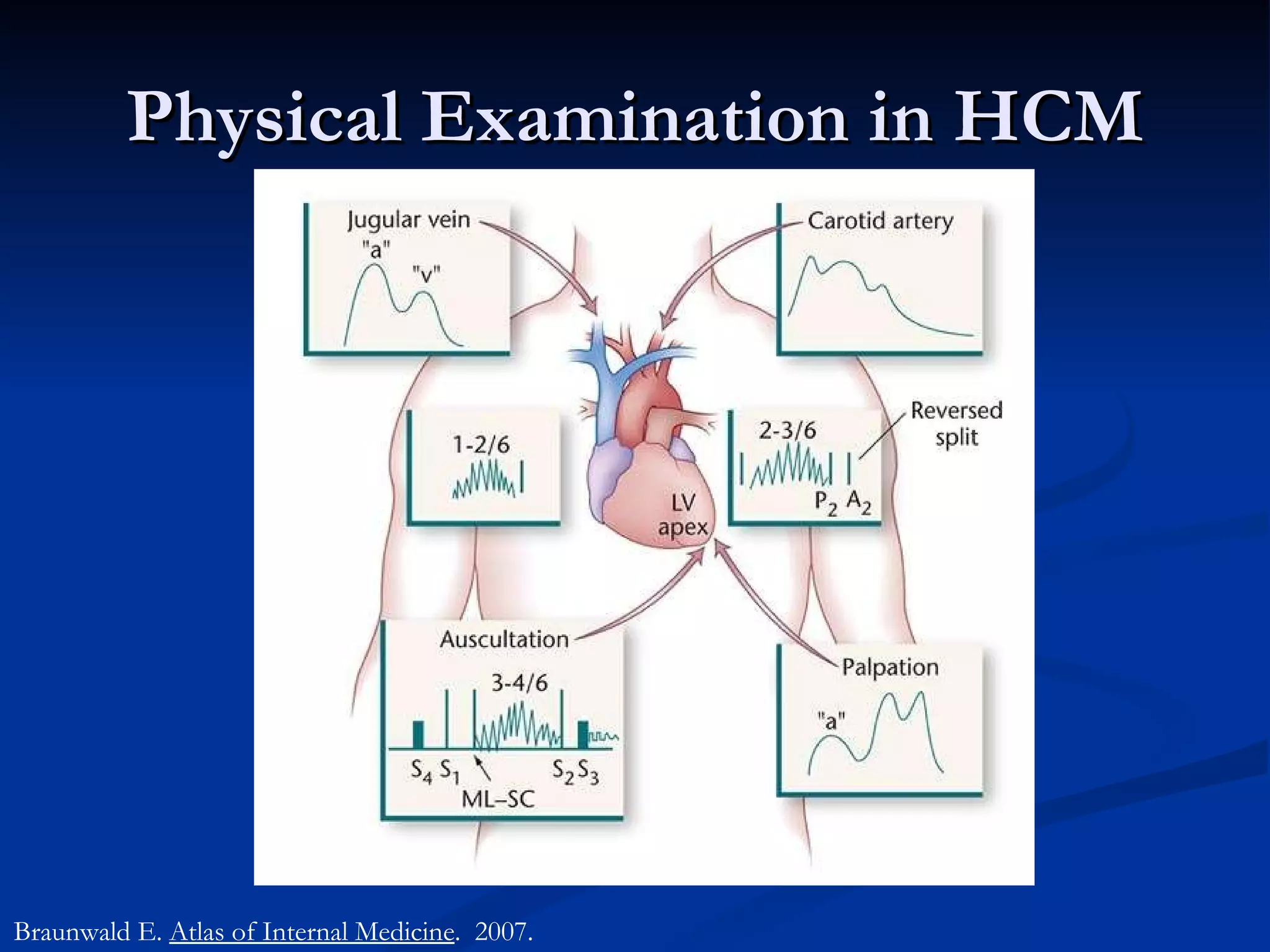 HYPERTROPHIC OBSTRUCTIVE CARDIOMYOPATHY (HOCM) | PPT