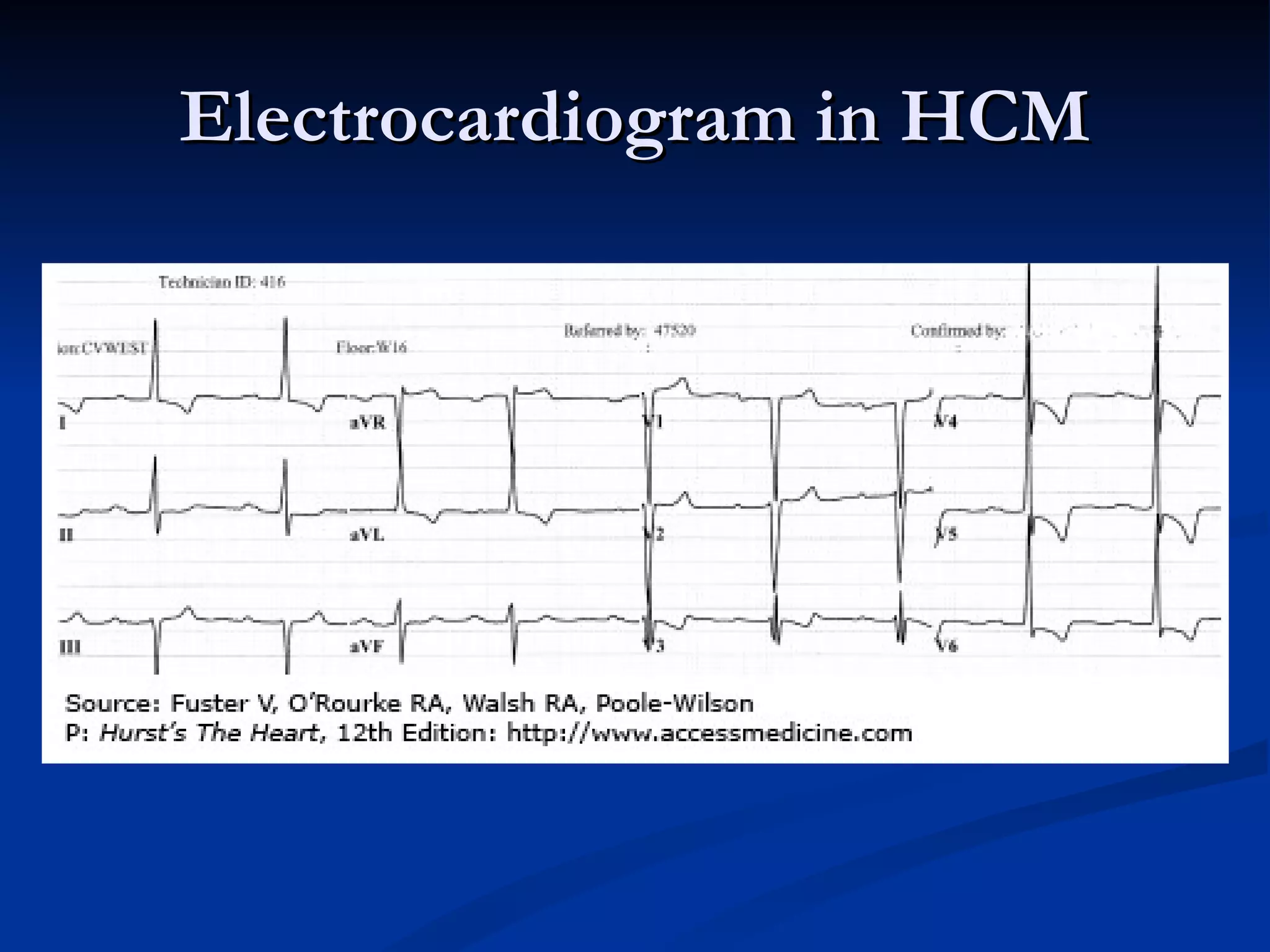 HYPERTROPHIC OBSTRUCTIVE CARDIOMYOPATHY (HOCM) | PPT