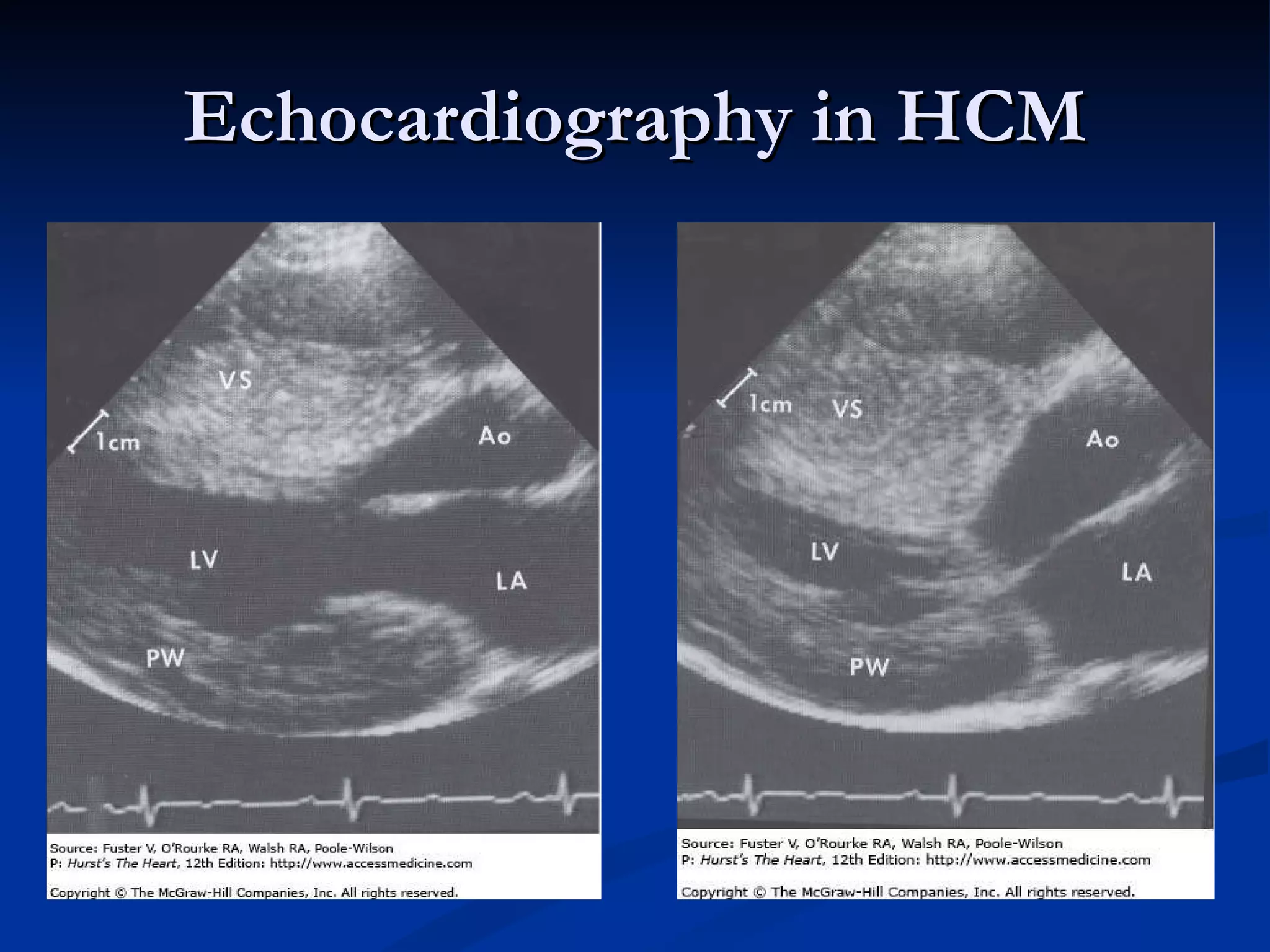 HYPERTROPHIC OBSTRUCTIVE CARDIOMYOPATHY (HOCM) | PPT