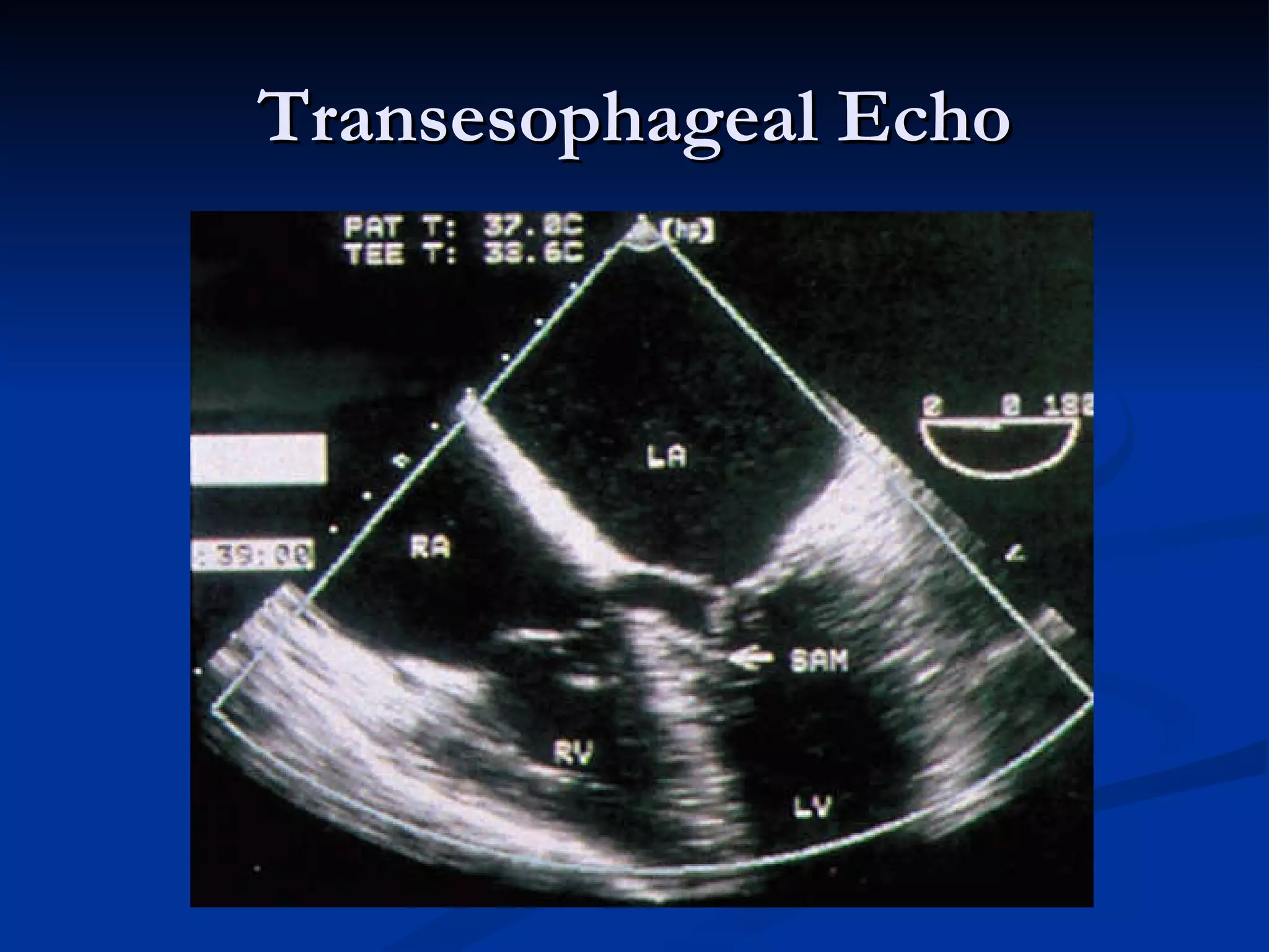 HYPERTROPHIC OBSTRUCTIVE CARDIOMYOPATHY (HOCM) | PPT