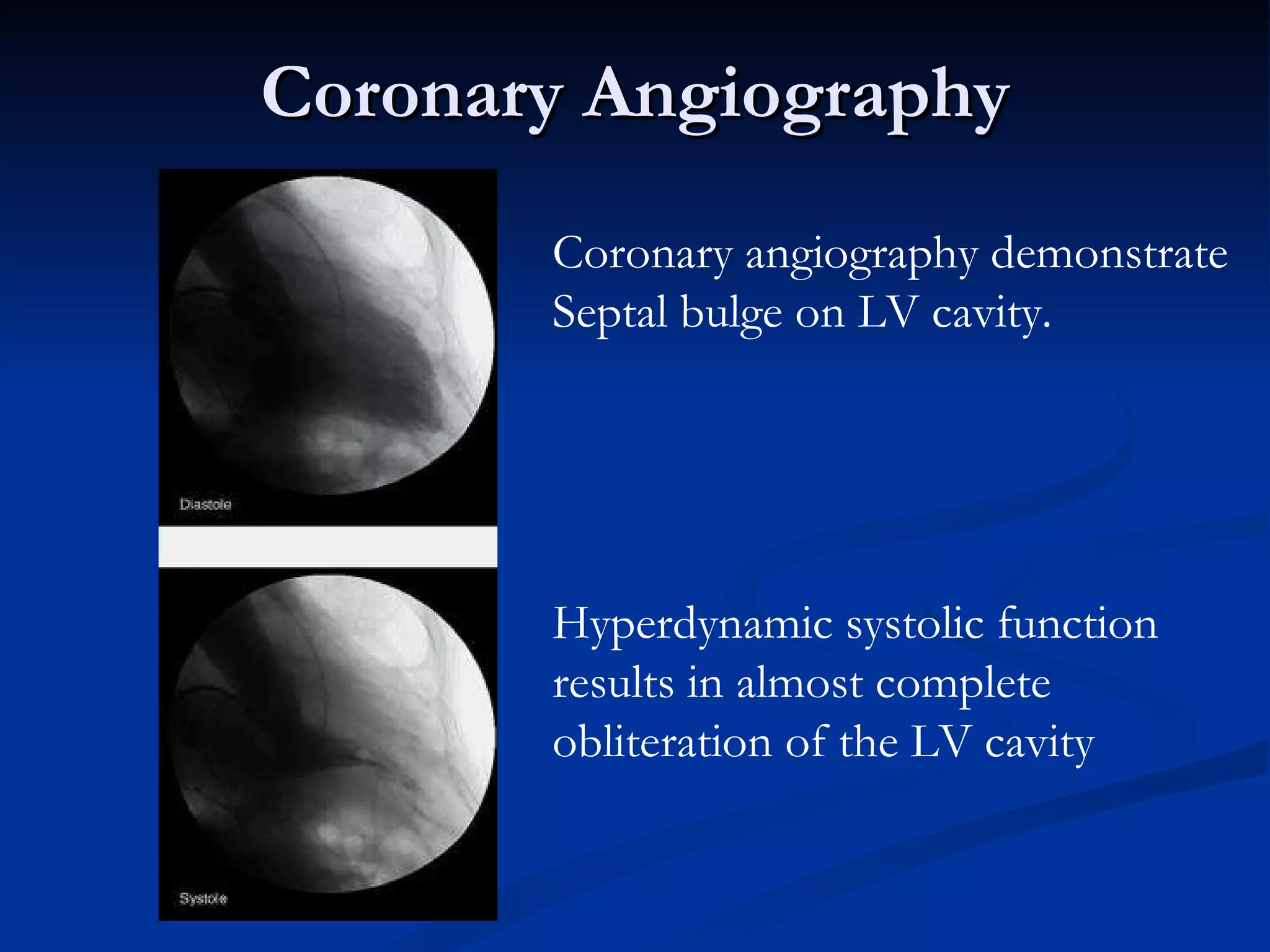 HYPERTROPHIC OBSTRUCTIVE CARDIOMYOPATHY (HOCM) | PPT