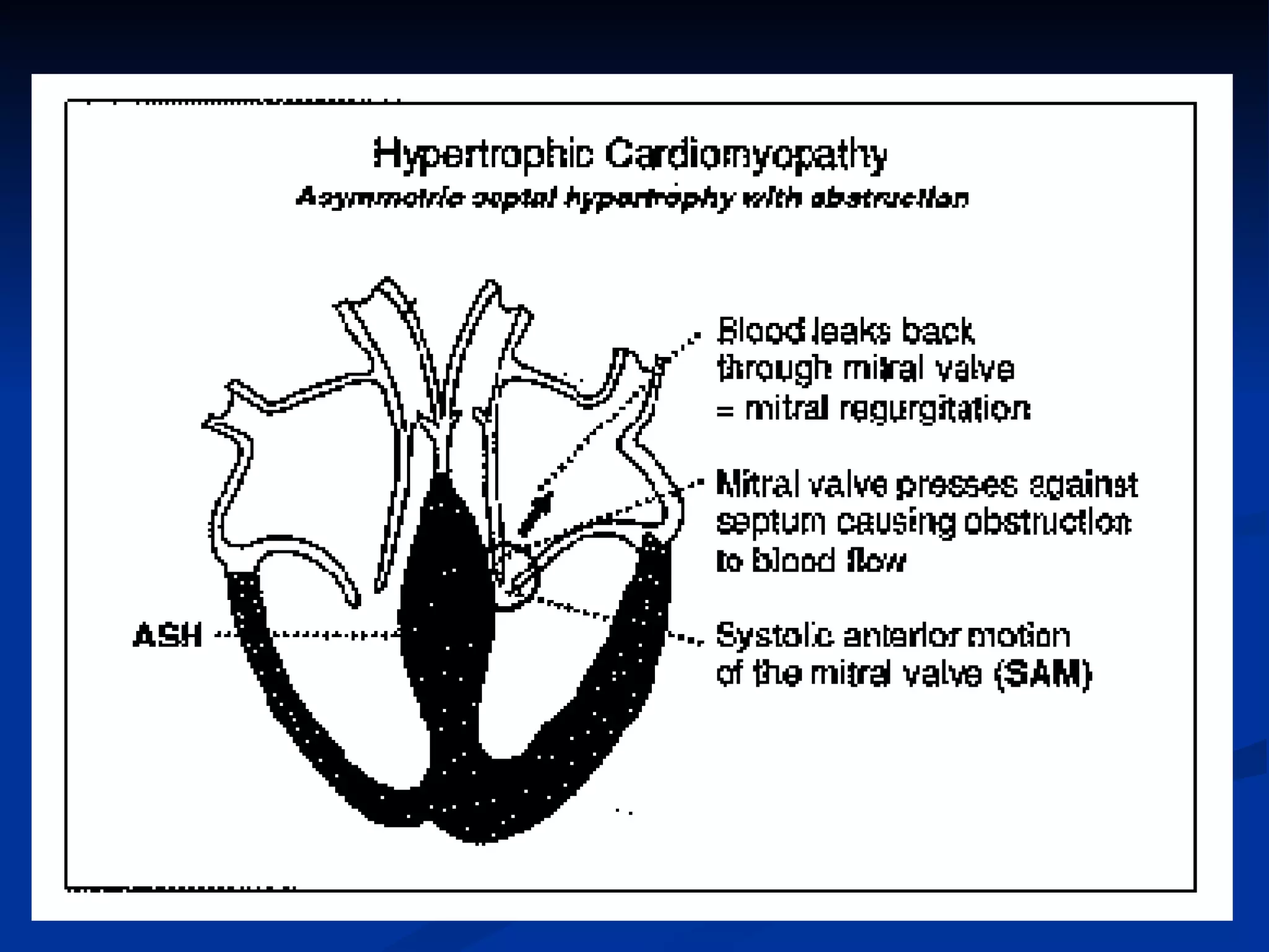 HYPERTROPHIC OBSTRUCTIVE CARDIOMYOPATHY (HOCM) | PPT