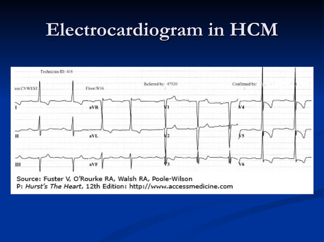 HYPERTROPHIC OBSTRUCTIVE CARDIOMYOPATHY (HOCM) | PPT