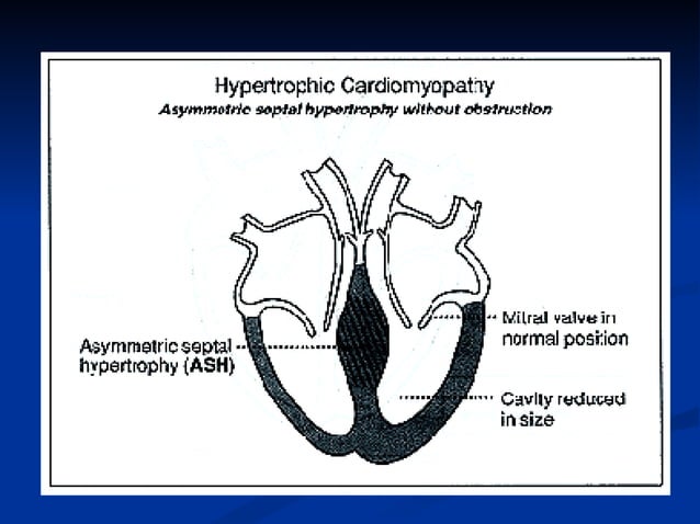 HYPERTROPHIC OBSTRUCTIVE CARDIOMYOPATHY (HOCM) | PPT