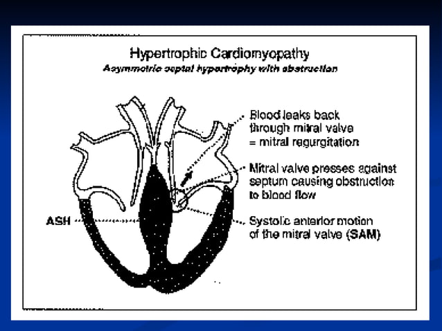 HYPERTROPHIC OBSTRUCTIVE CARDIOMYOPATHY (HOCM) | PPT