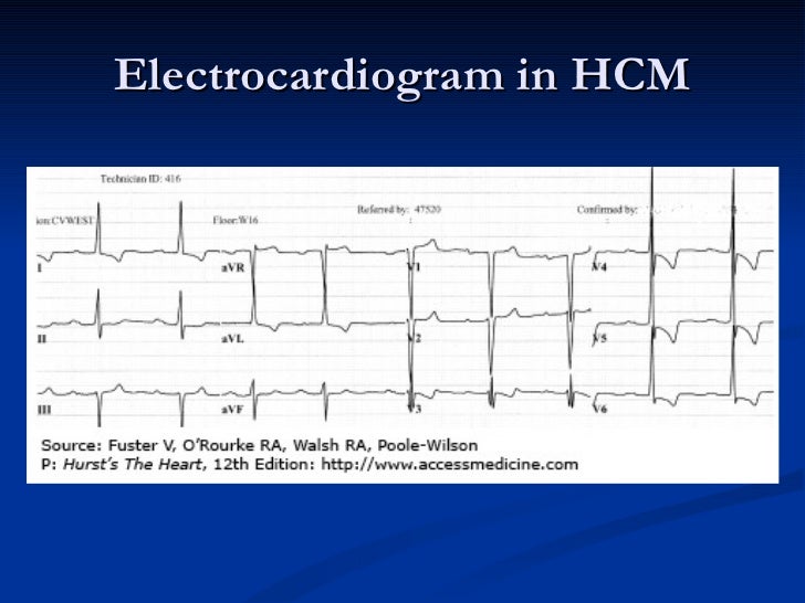 HYPERTROPHIC OBSTRUCTIVE CARDIOMYOPATHY (HOCM)