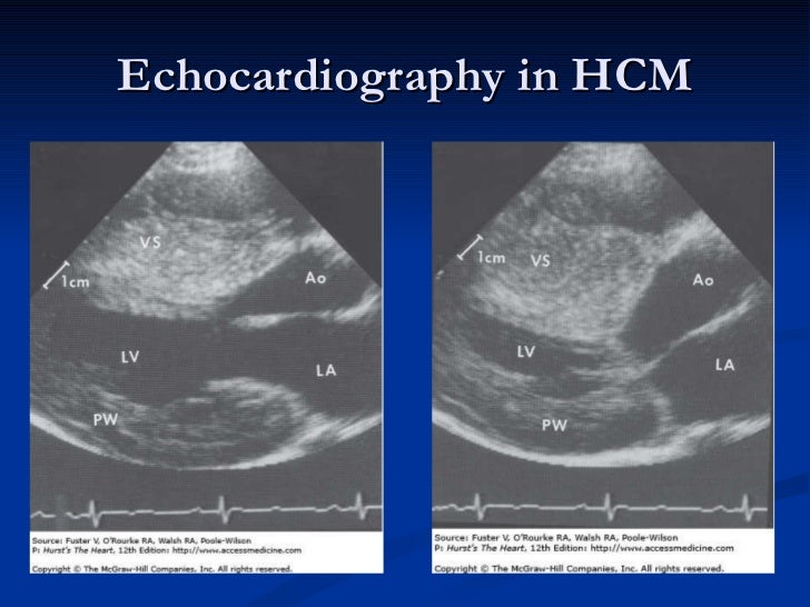 HYPERTROPHIC OBSTRUCTIVE CARDIOMYOPATHY (HOCM)
