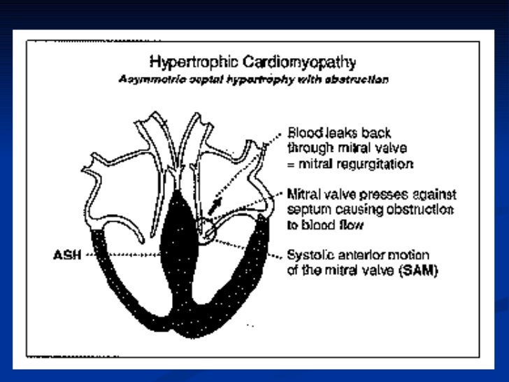 HYPERTROPHIC OBSTRUCTIVE CARDIOMYOPATHY (HOCM)