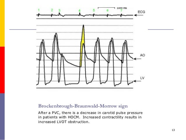 HOCM - IHSS – Brockenbrough Ronald sign. Post PVC increase in LVA a ...
