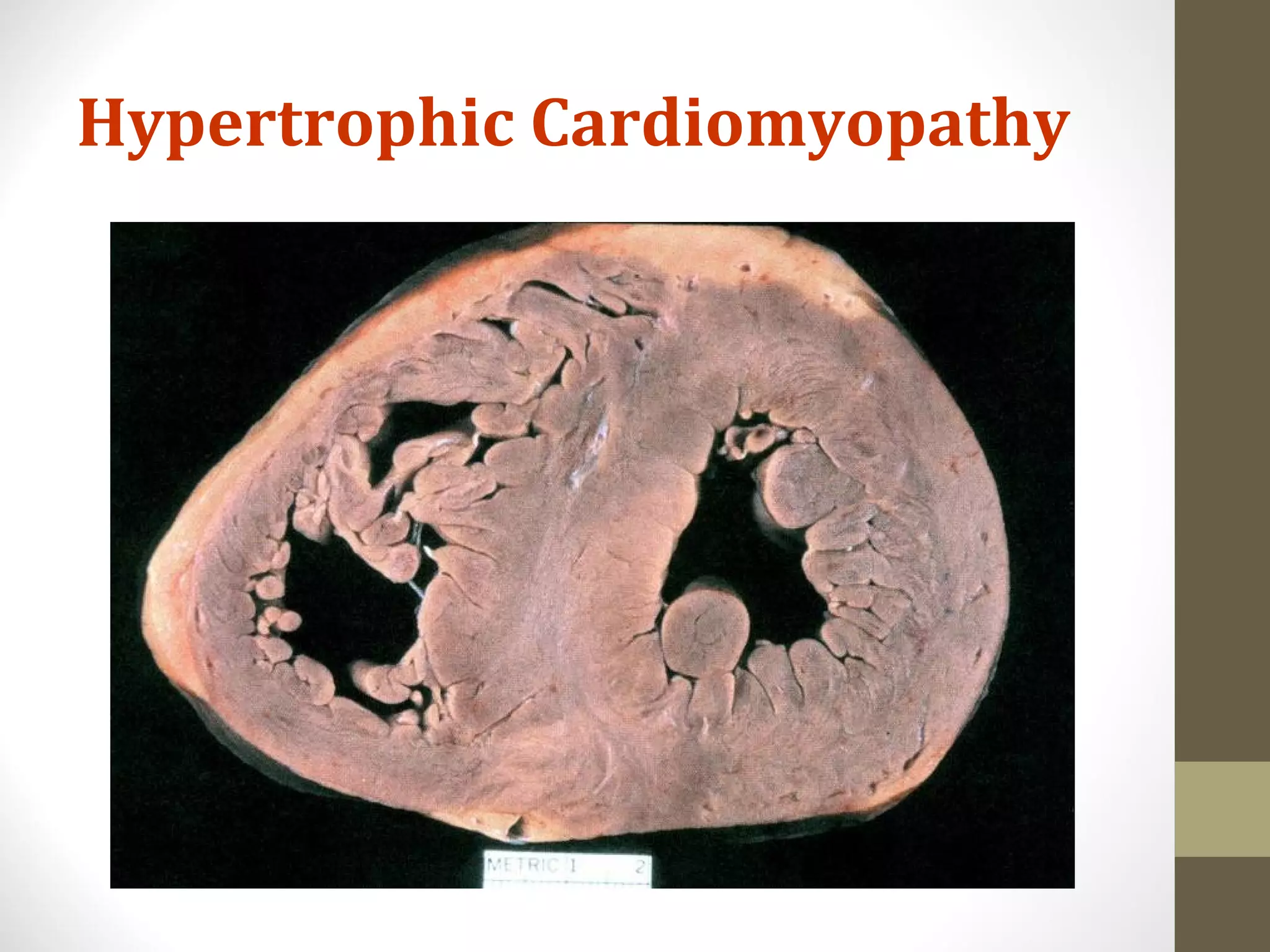 HOCM Hypertrophic cardiomyopathy | PPT