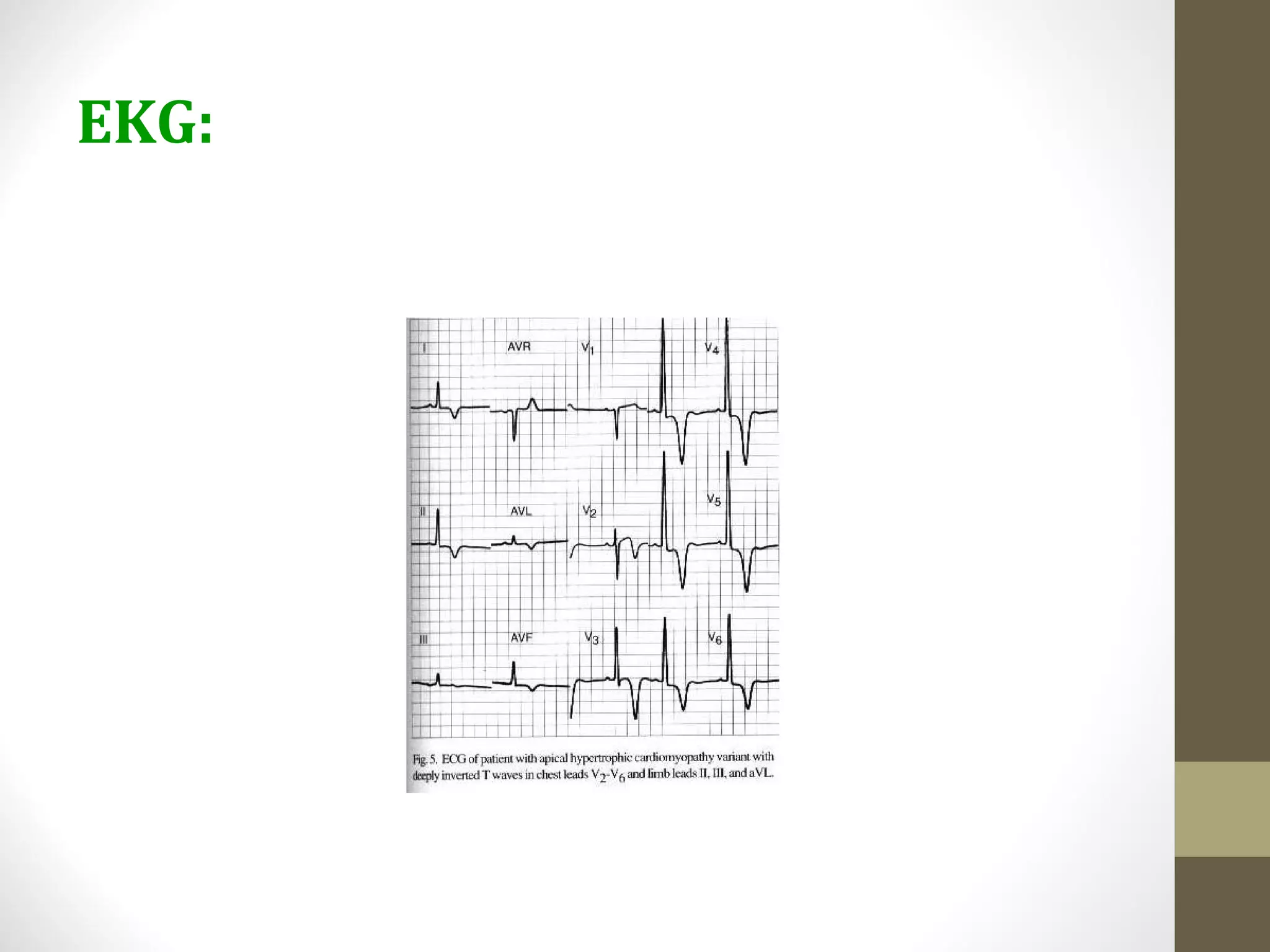 HOCM Hypertrophic cardiomyopathy | PPT