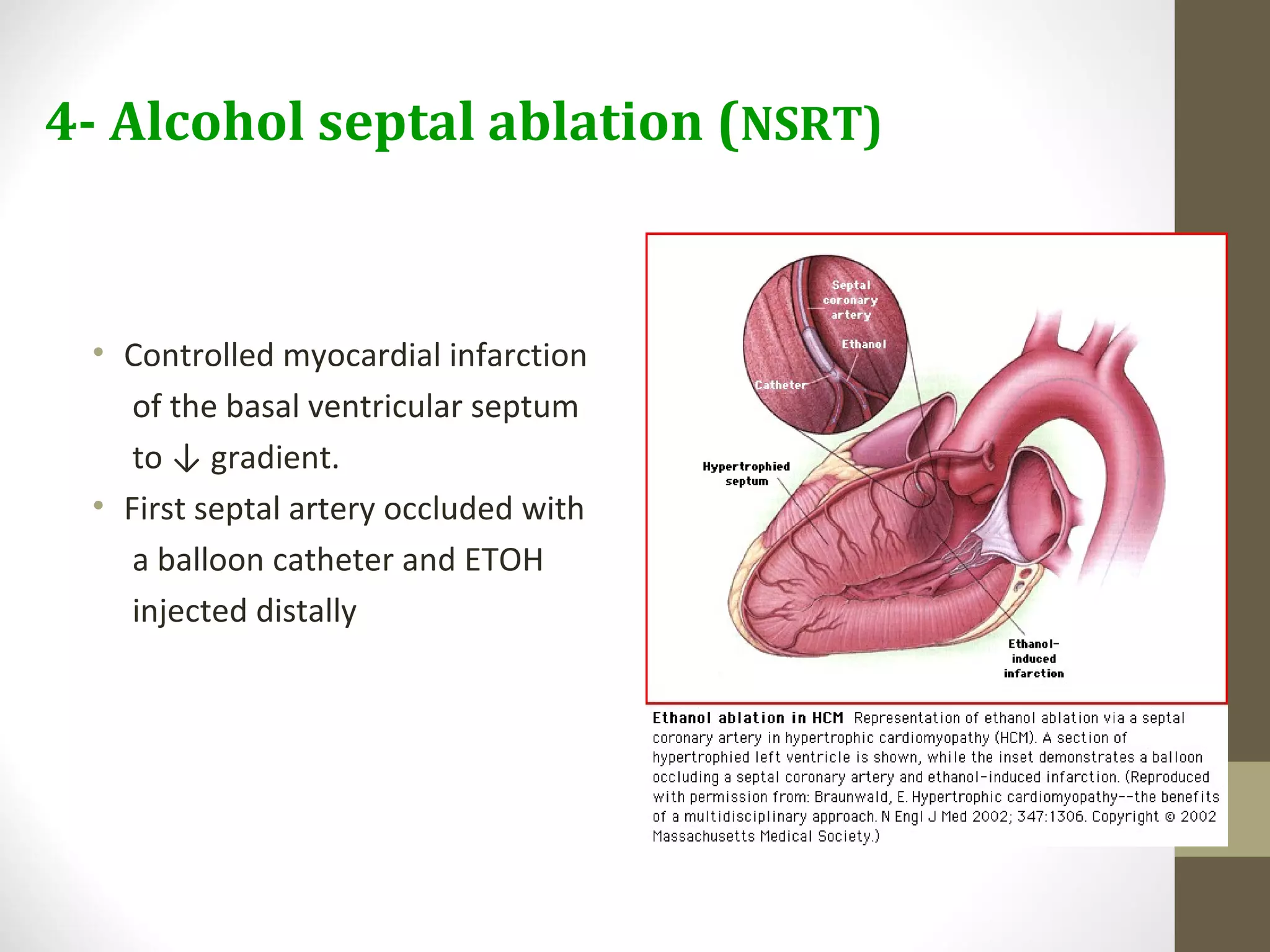 HOCM Hypertrophic cardiomyopathy | PPT