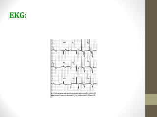 HOCM Hypertrophic cardiomyopathy | PPT