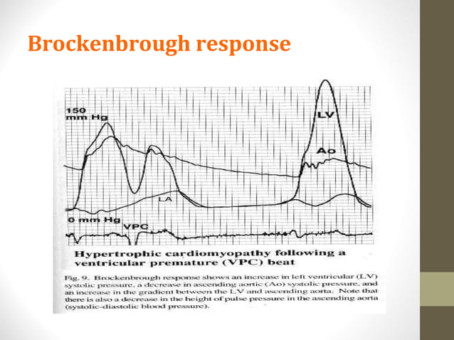 HOCM Hypertrophic cardiomyopathy | PPT | Heart and Cardiovascular ...