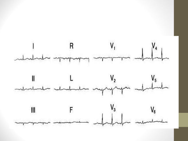 HOCM Hypertrophic cardiomyopathy | PPT | Heart and Cardiovascular ...