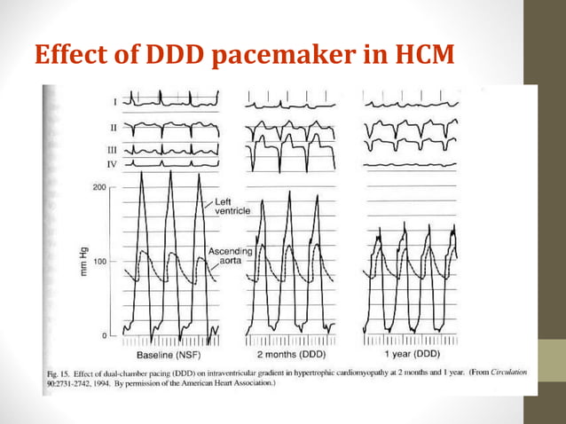 HOCM Hypertrophic cardiomyopathy | PPT | Heart and Cardiovascular ...