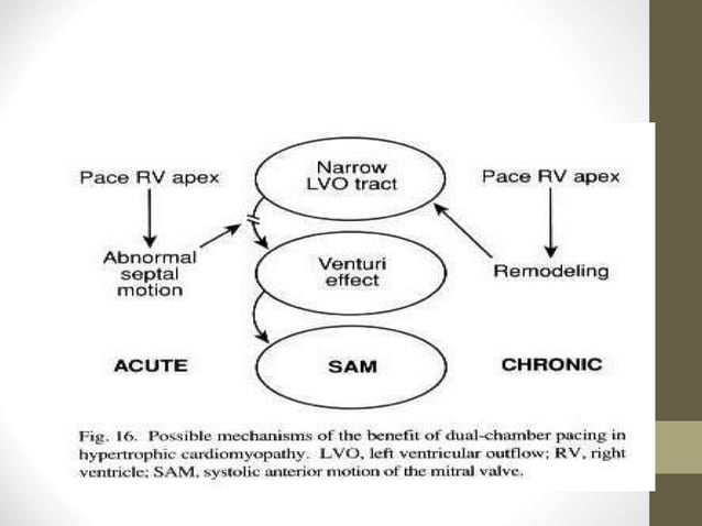 HOCM Hypertrophic cardiomyopathy | PPT | Heart and Cardiovascular ...
