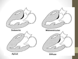 HOCM Hypertrophic cardiomyopathy | PPT