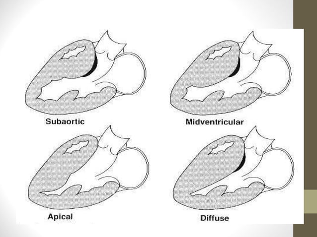 HOCM Hypertrophic cardiomyopathy | PPT | Heart and Cardiovascular ...