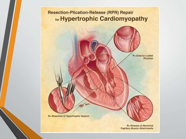 Management of HOCM | PPT