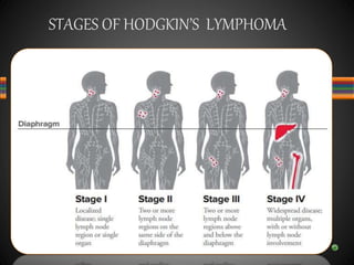 Hodgekin's ppt | PPTX