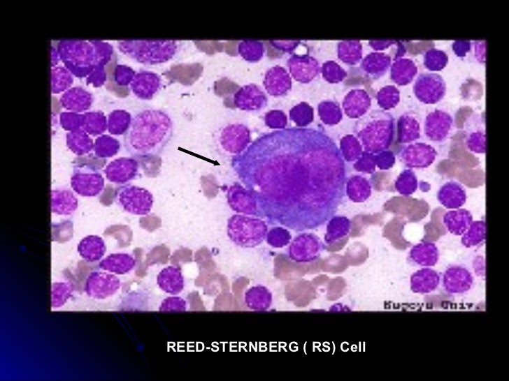 Hodgkin lymphoma