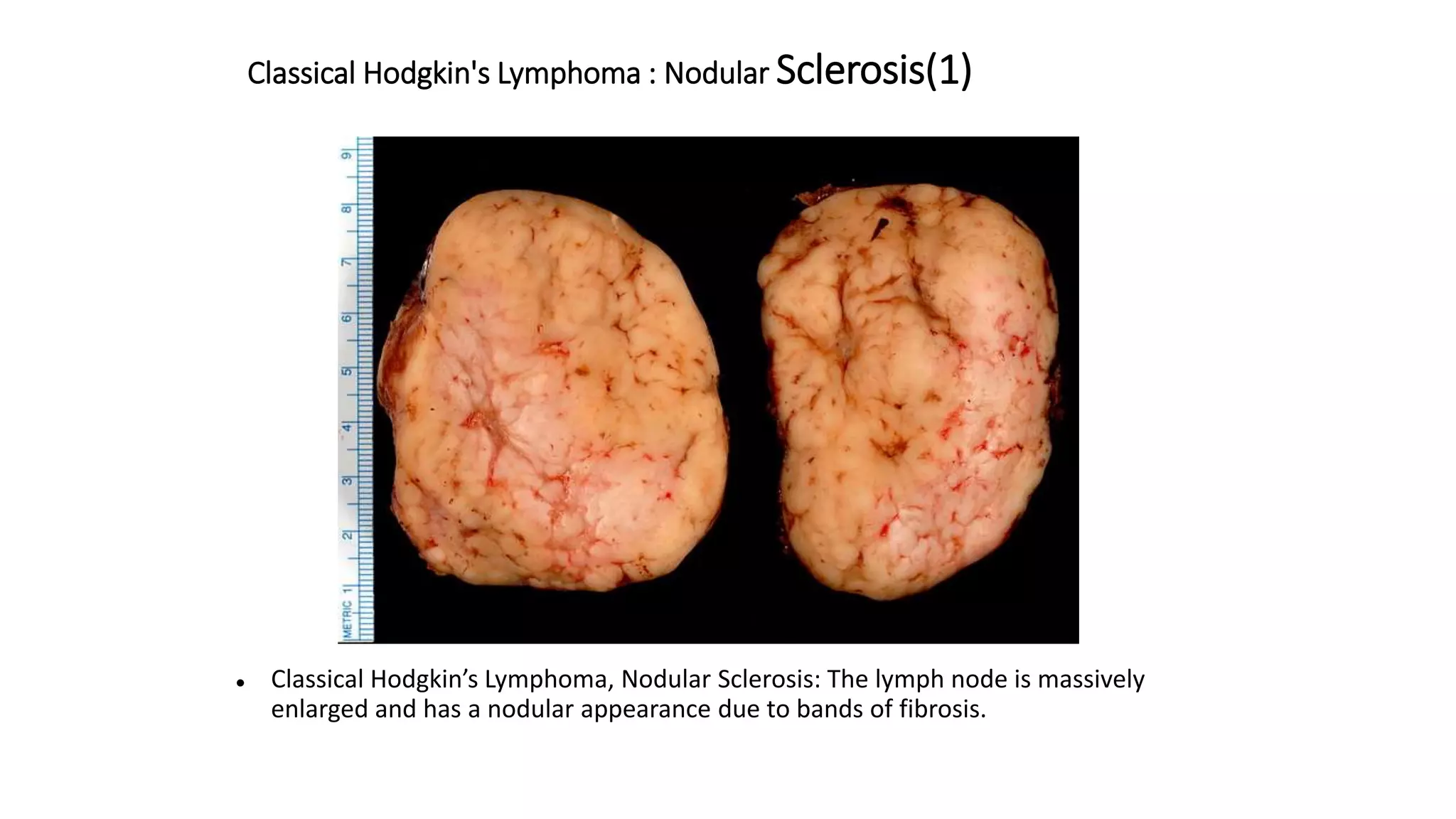 Hodgkin lymphoma | PPTX