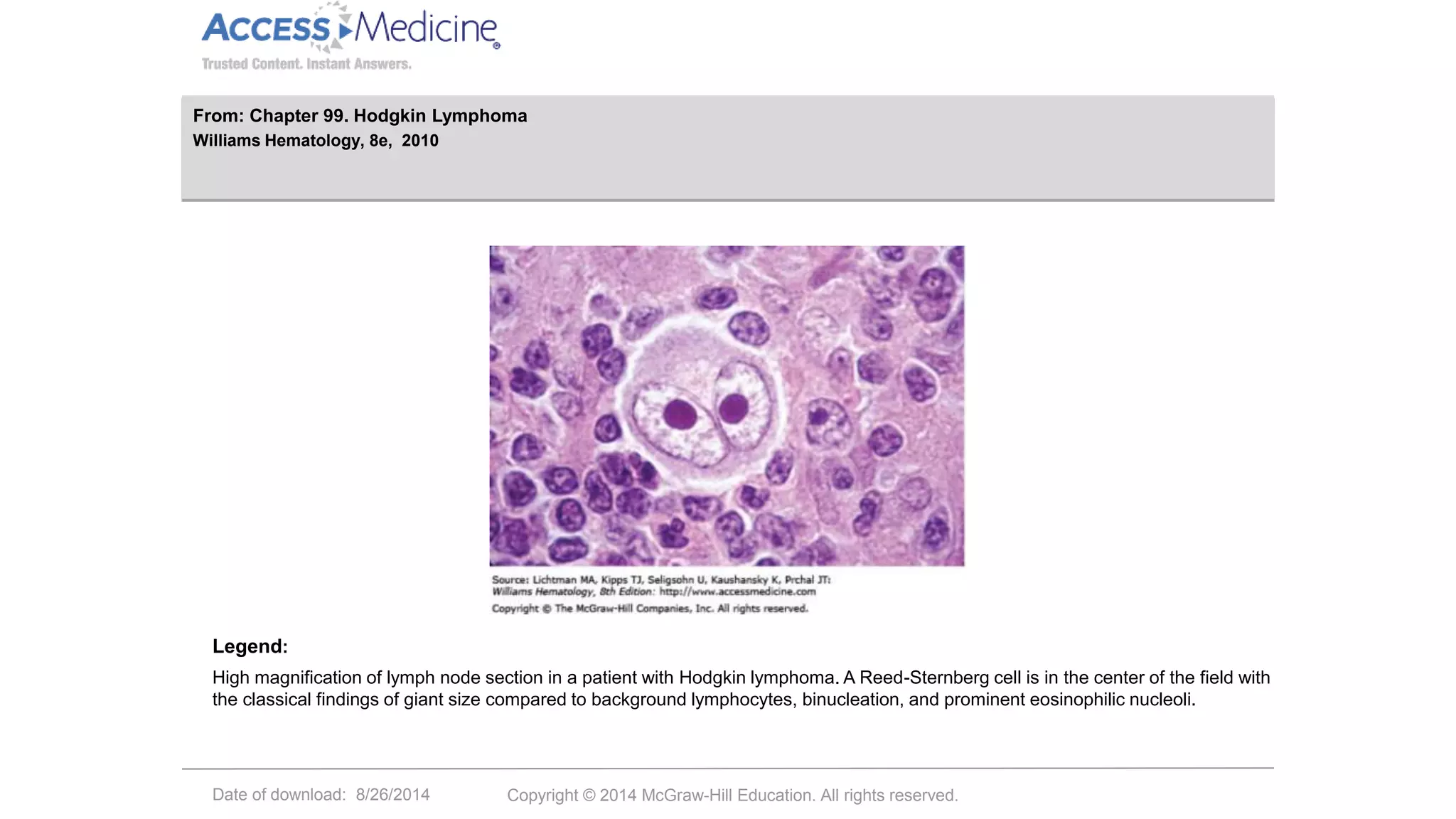 Hodgkin lymphoma | PPTX