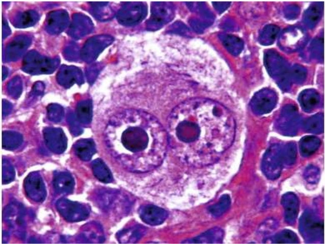 Hodgkin lymphoma
