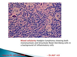 Hodgkin lymphoma | PPTX | Cancer | Diseases and Conditions