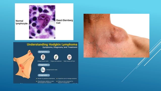 hodgkin lyphoma | PPT