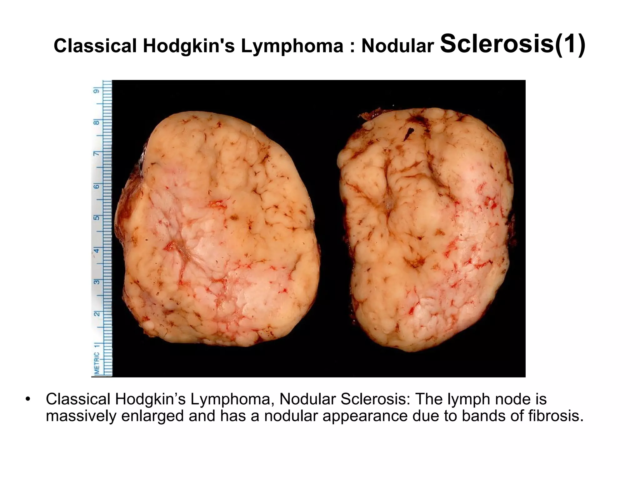 Hodgkins Lymphoma | PPS