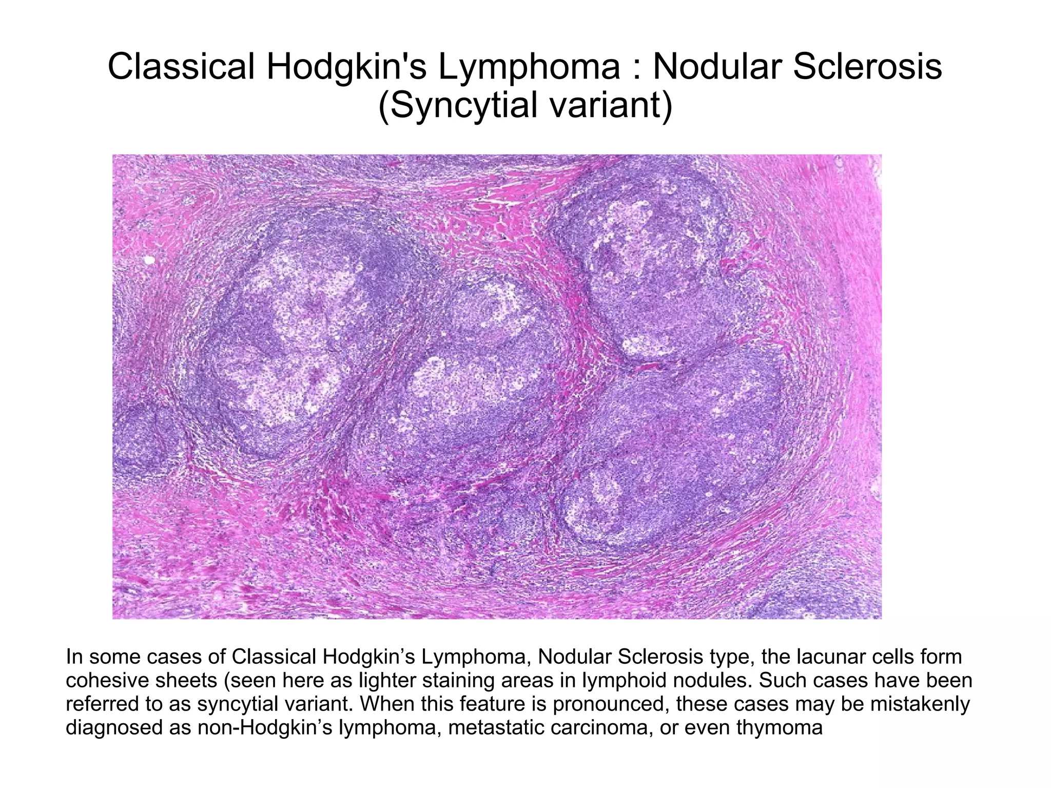 Hodgkins Lymphoma | PPS