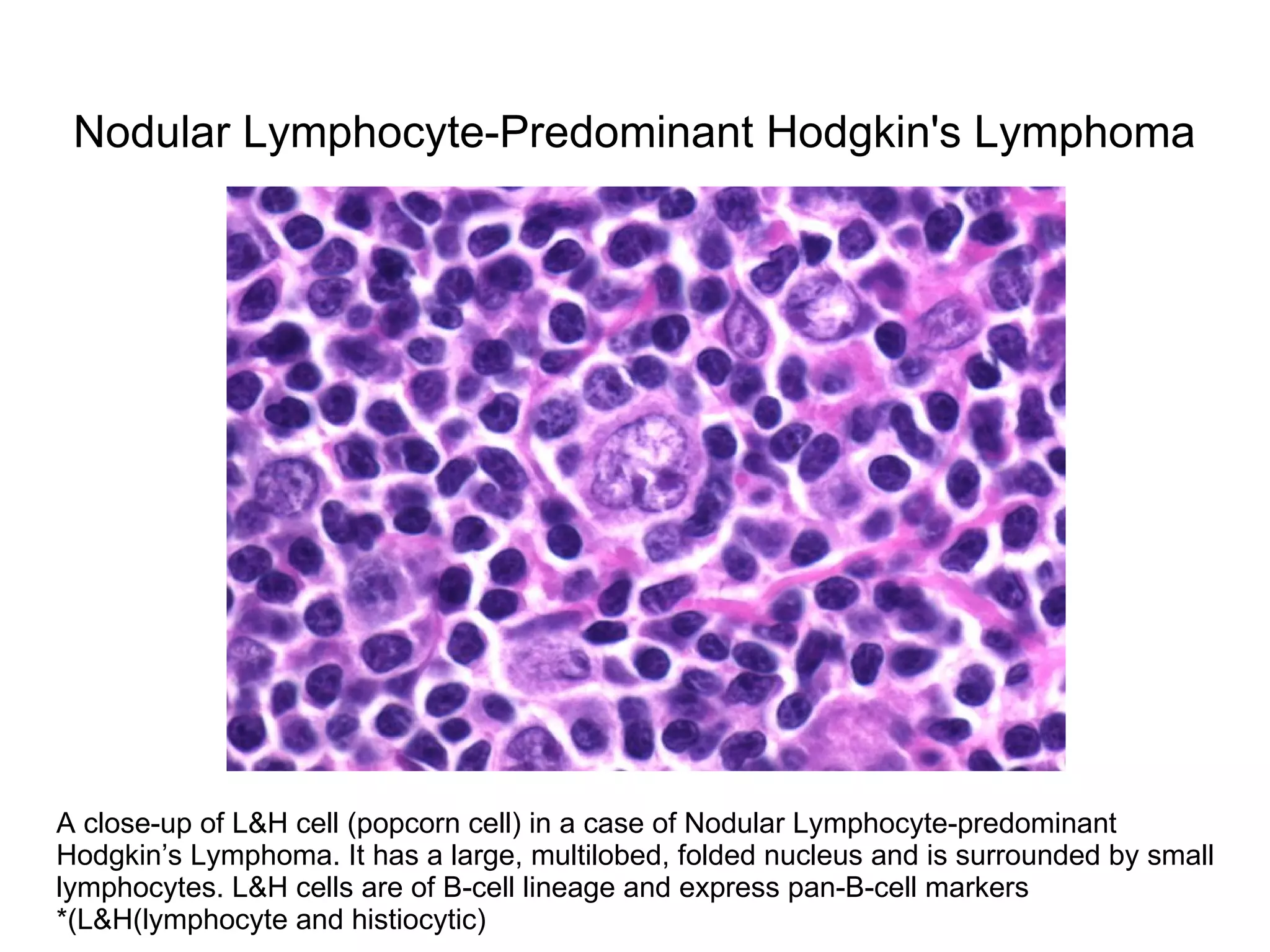Hodgkins Lymphoma | PPS