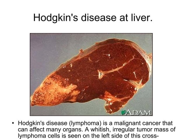 Hodgkins Lymphoma | PPS