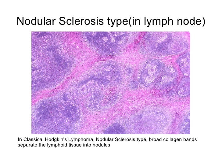 Hodgkins Lymphoma