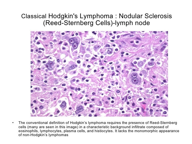 Hodgkins Lymphoma