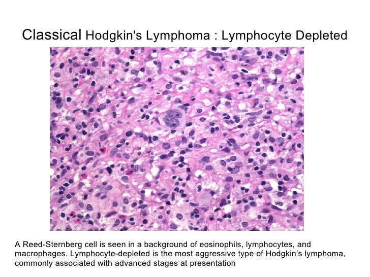 Hodgkins Lymphoma