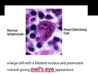 Hodgkin's lymphoma | PPTX