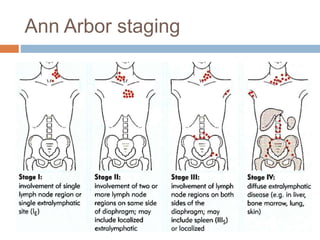 Hodgkin’s lymphoma | PPTX